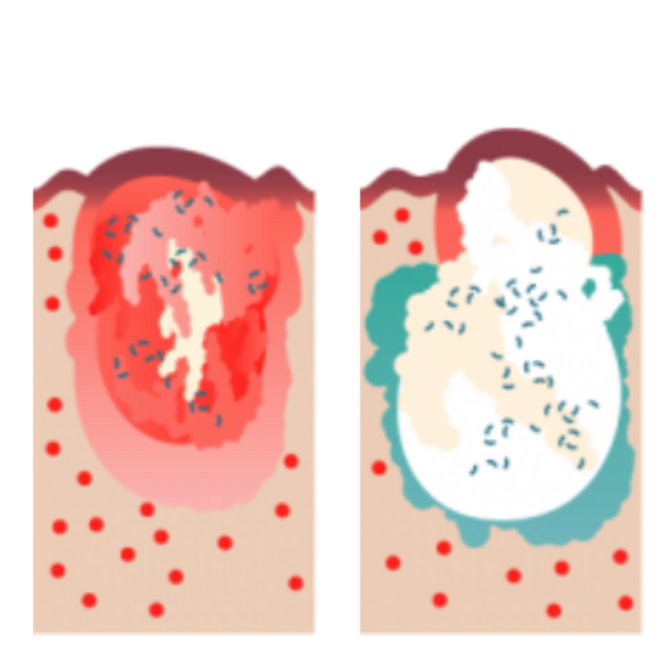 How does acne develop? - Acne Action - Acne and Rosacea Society of Canada
